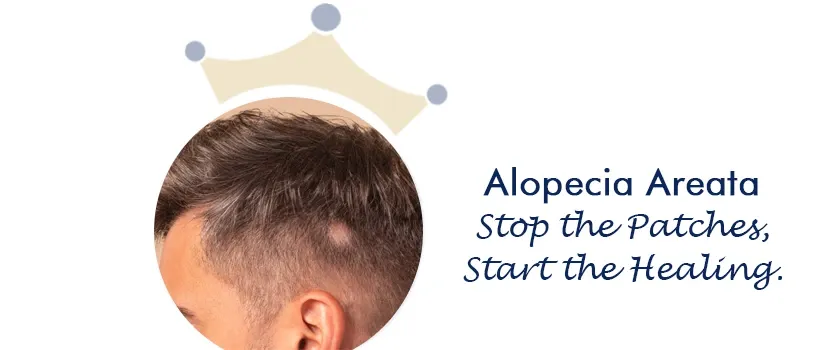 Alopecia Areata Treatment in Ahmedabad | Patchy Hair Loss